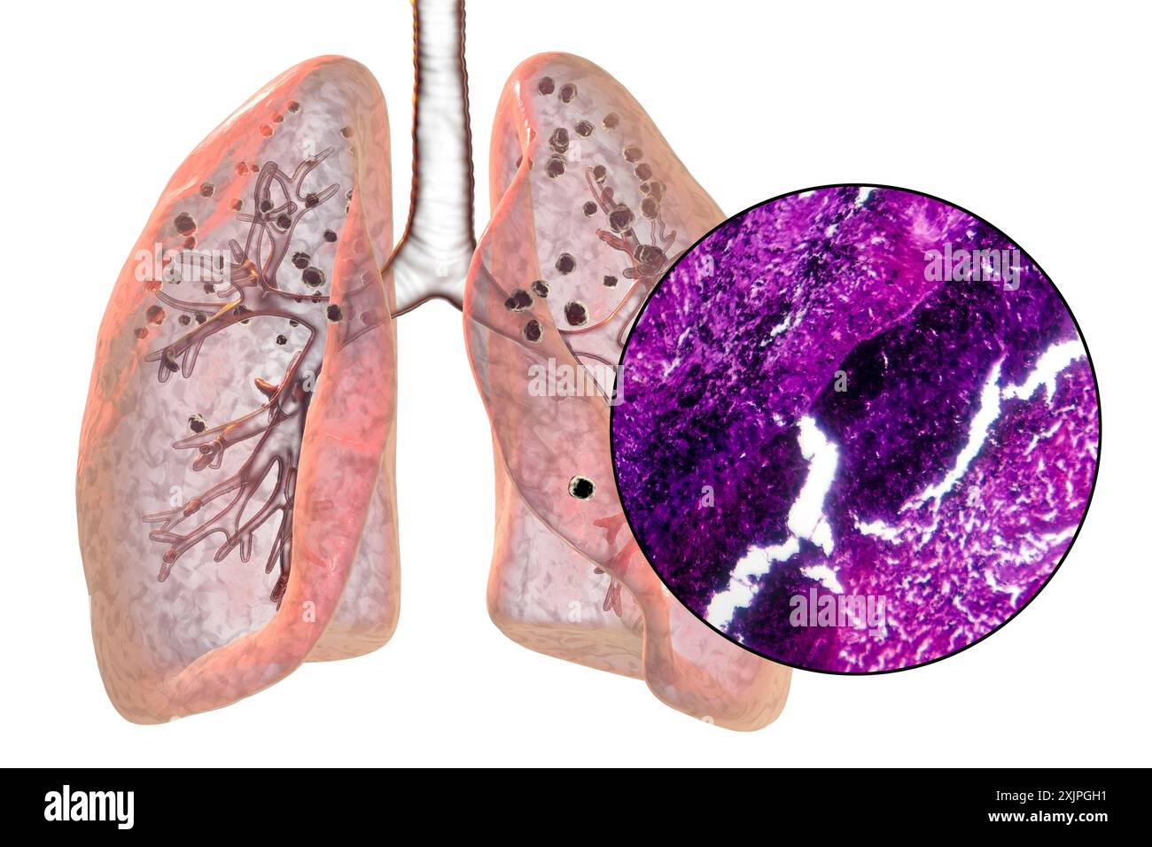 Illustration depicting lungs affected by silicosis, revealing dark ...