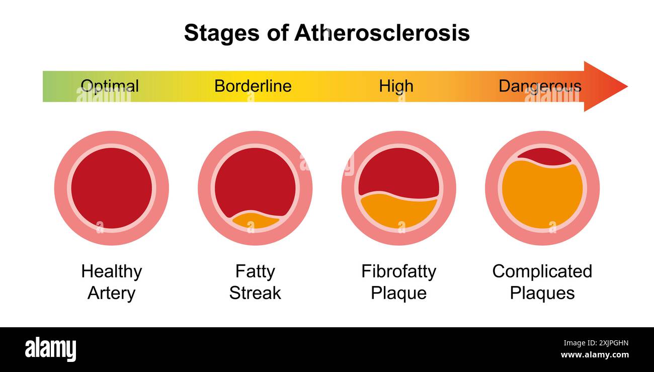 Atherosclerosis stages hi-res stock photography and images - Alamy