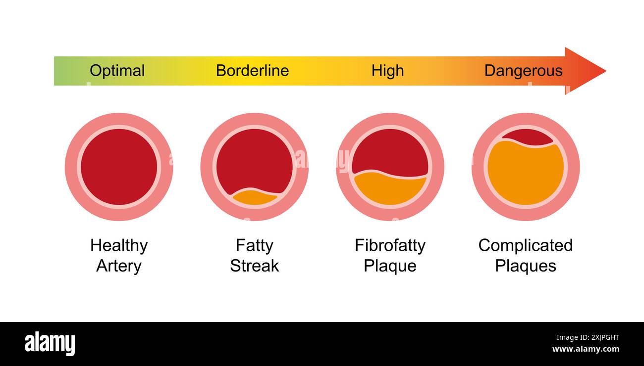 Atherosclerosis stages, illustration Stock Photo - Alamy