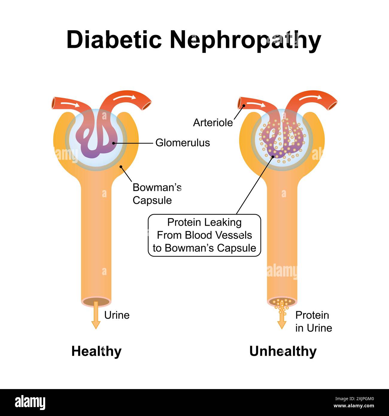 Diabetic nephropathy, illustration Stock Photo - Alamy