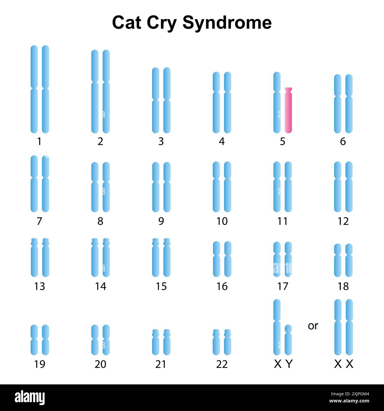 Cat cry syndrome, illustration Stock Photo - Alamy
