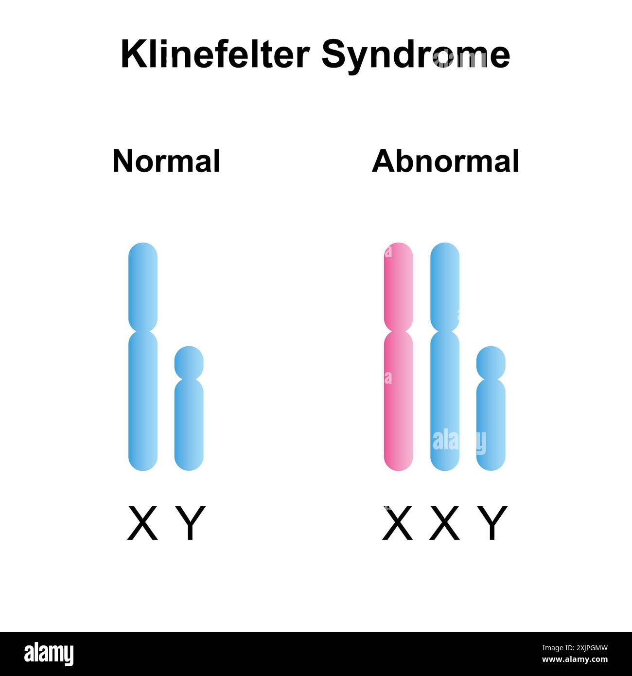 Xxy syndrome karyotype hi-res stock photography and images - Alamy