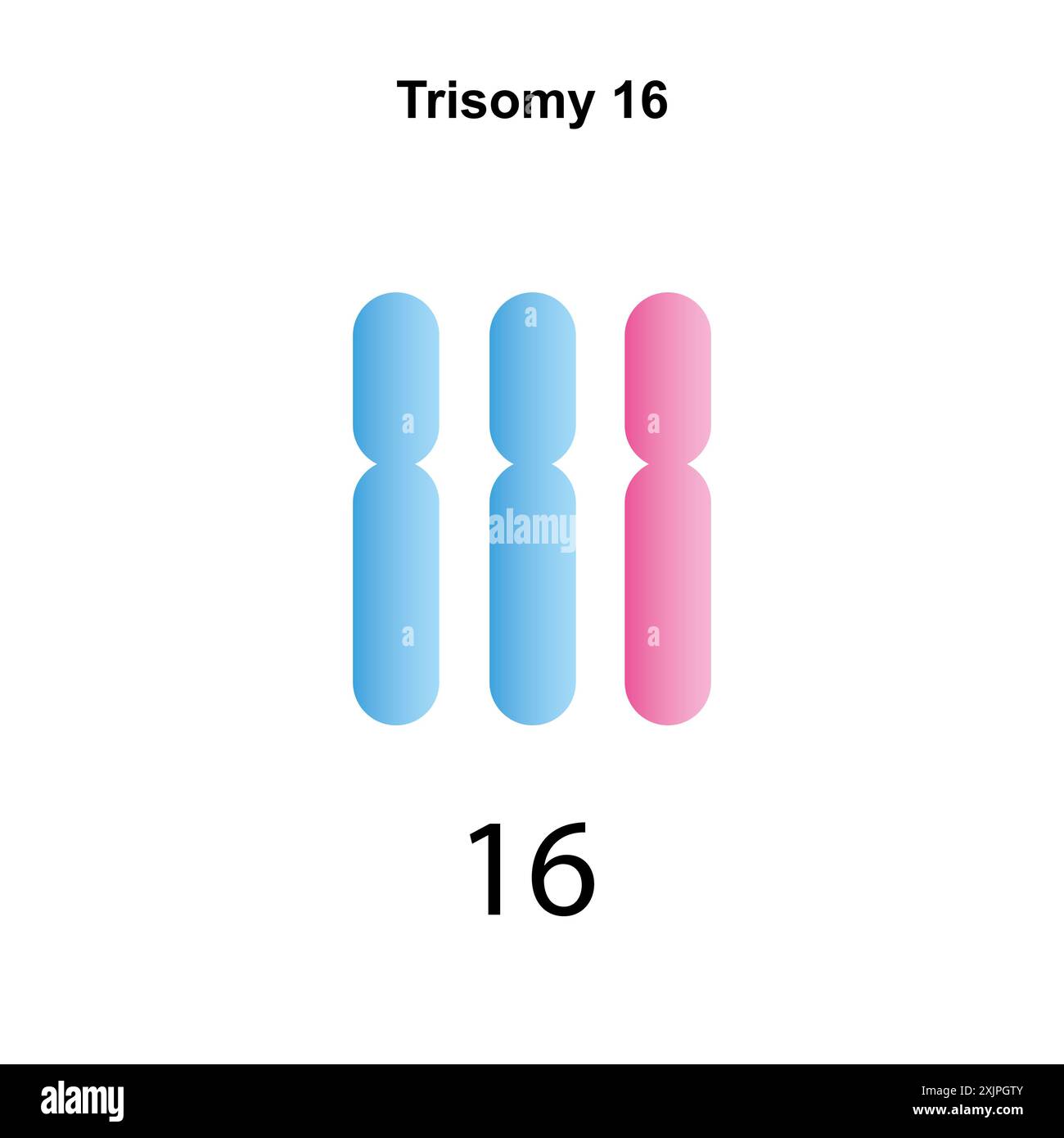 Trisomy 16 hi-res stock photography and images - Alamy
