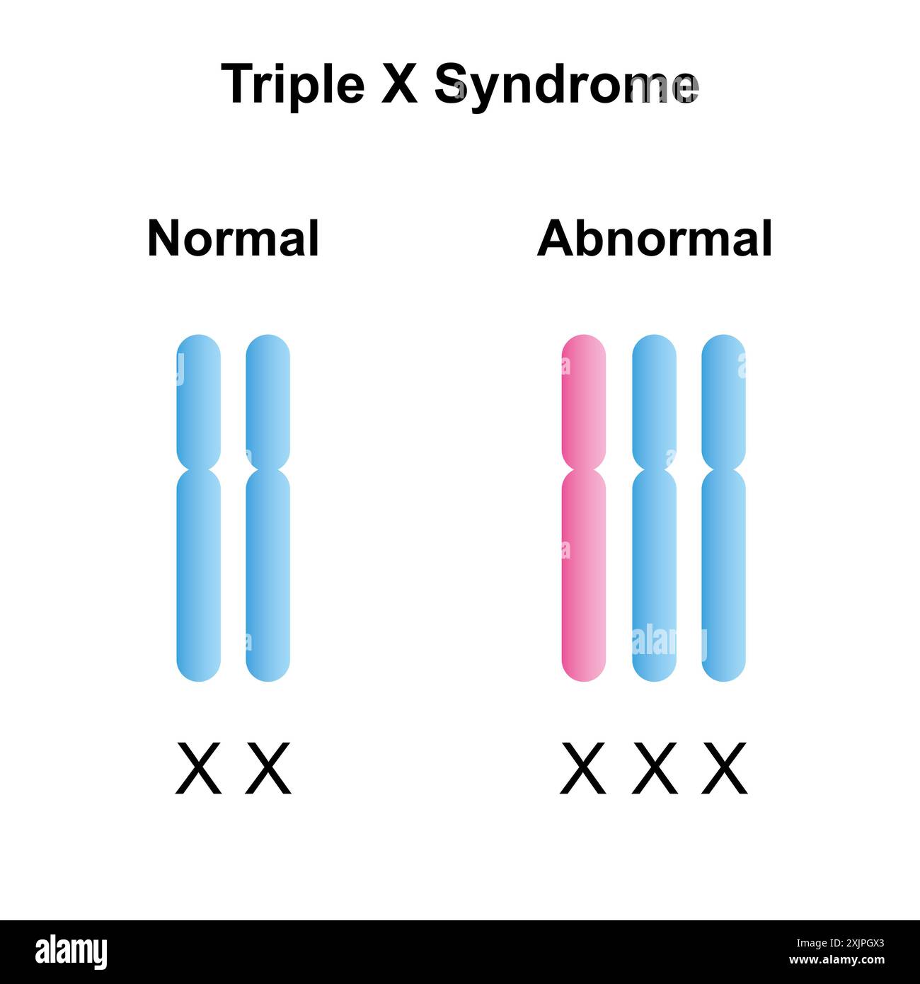 Triple x syndrome, illustration Stock Photo - Alamy