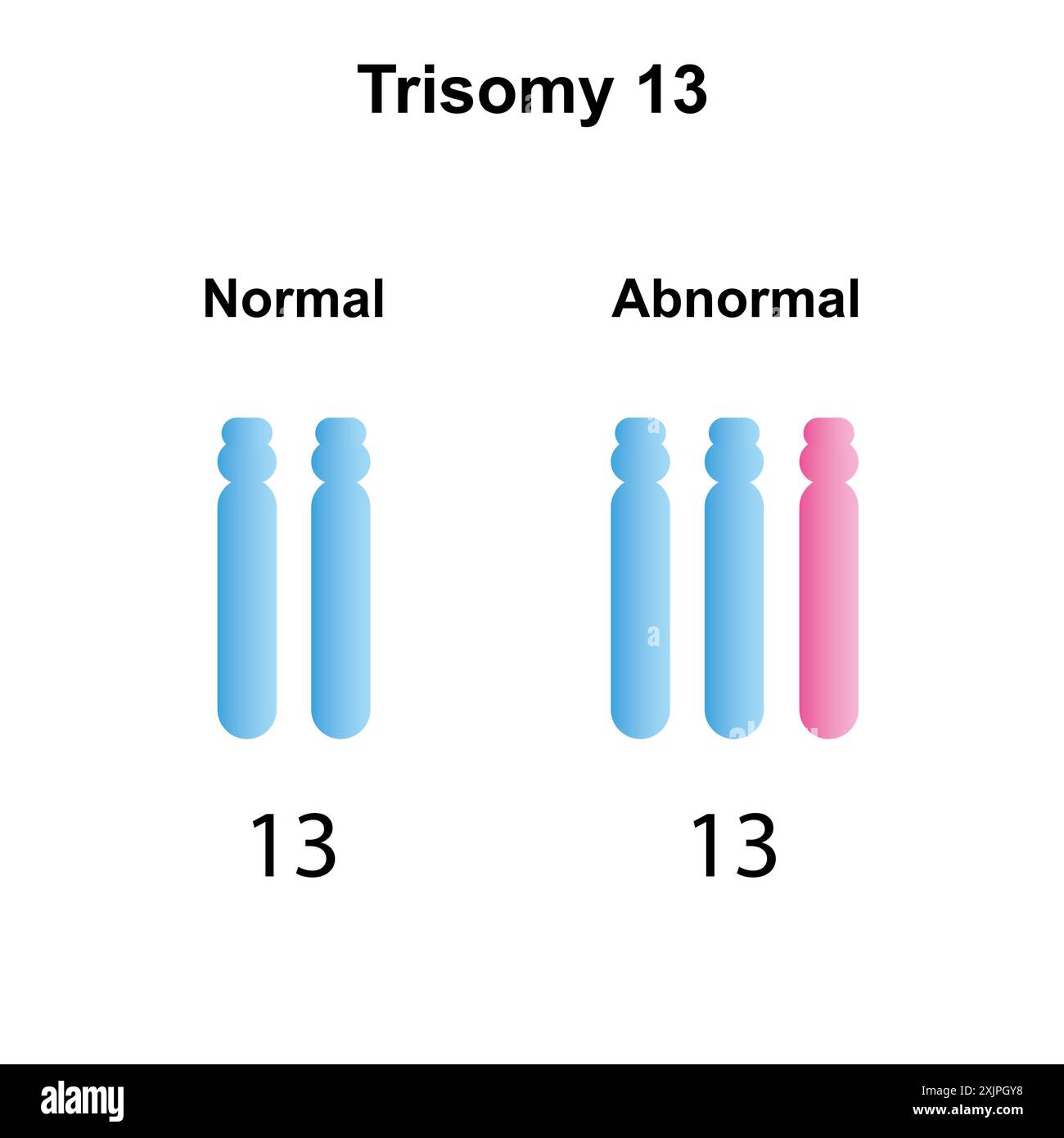 Trisomy 13 karyotype hi-res stock photography and images - Alamy