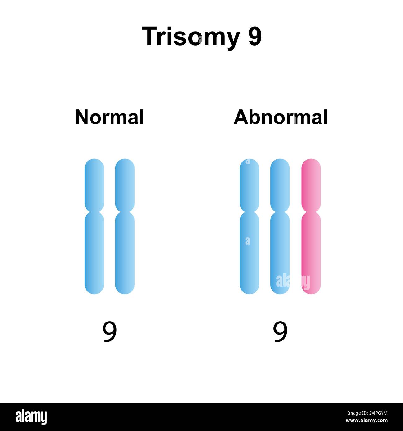 Trisomy 9 syndrome, illustration Stock Photo - Alamy