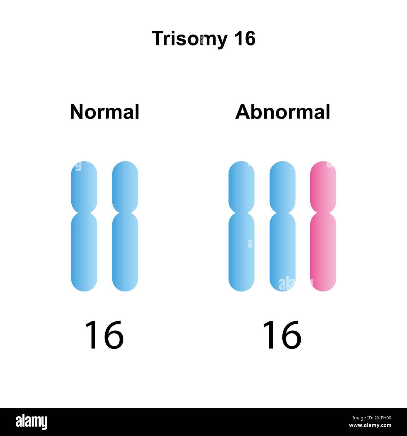 Trisomy 16 hi-res stock photography and images - Alamy