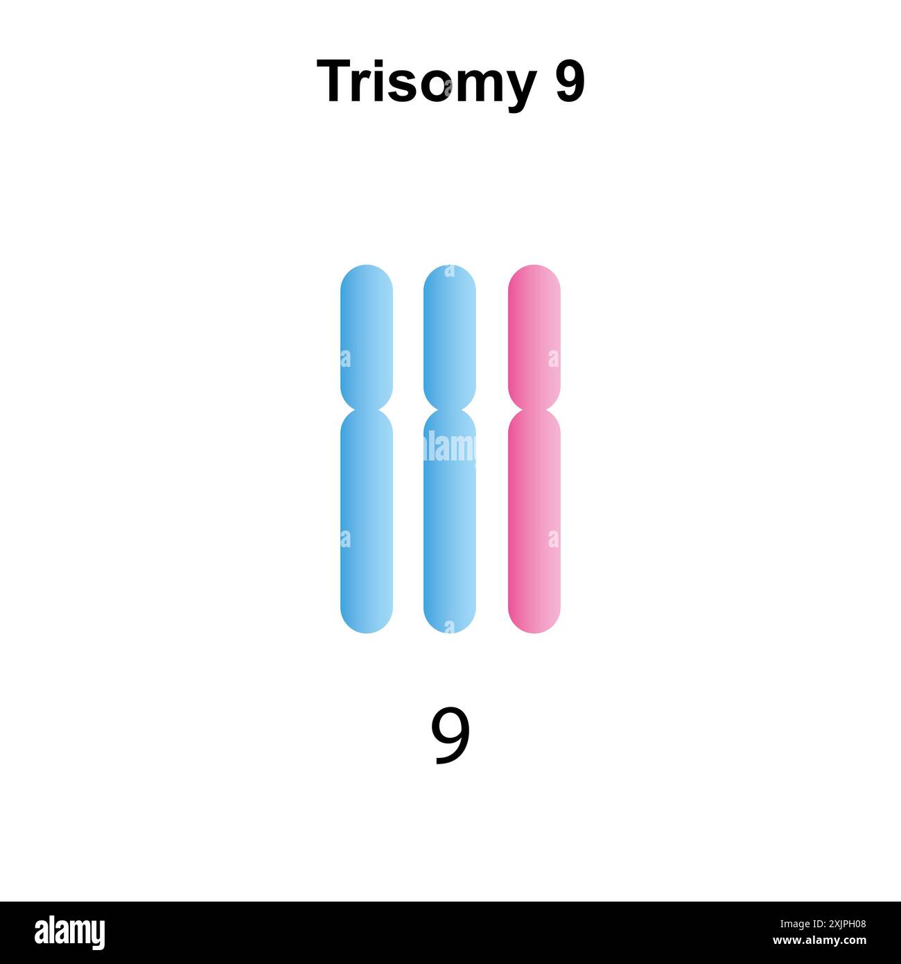 Trisomy 9 syndrome, illustration Stock Photo - Alamy