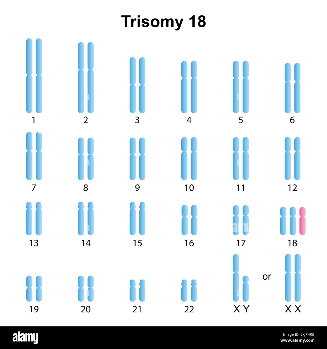 Trisomy 18 syndrome, illustration Stock Photo - Alamy