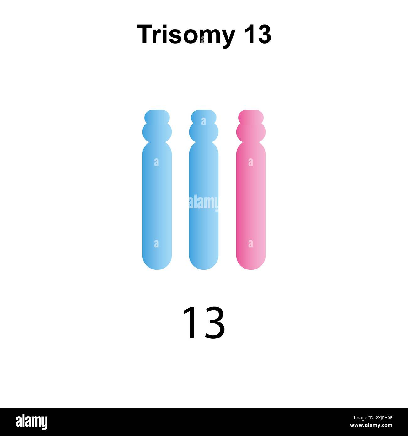 Trisomy 13 syndrome, illustration Stock Photo - Alamy