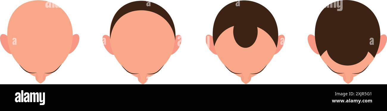 Hair loss bald head alopecia transplant growth vector top view. Hair ...