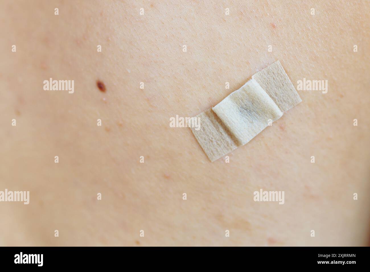 tick bite wound on back, medical plaster on skin back, anti ...