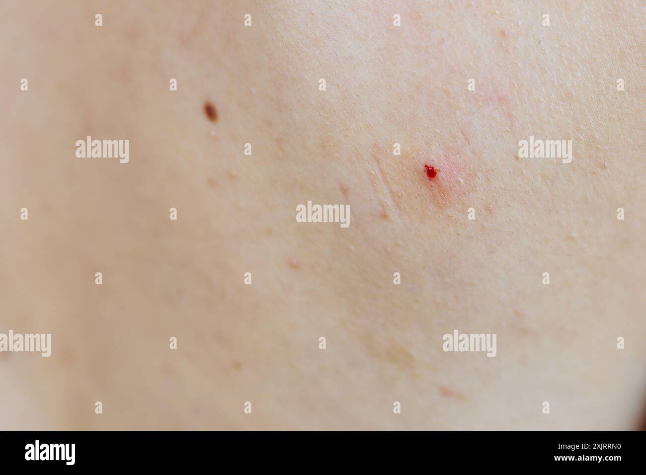 Back wound hi-res stock photography and images - Alamy