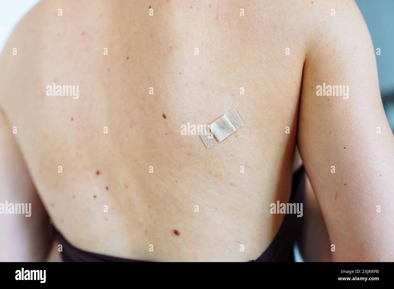 tick bite wound on back, medical plaster on skin back, anti ...