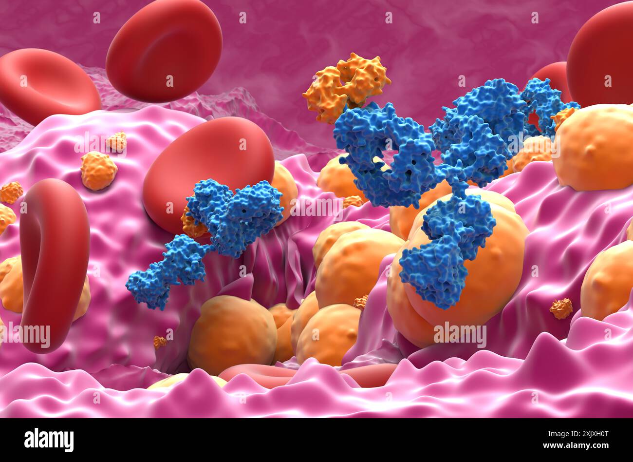 Monoclonal antibody treatment in Basal-cell carcinoma (BCC) - closeup ...