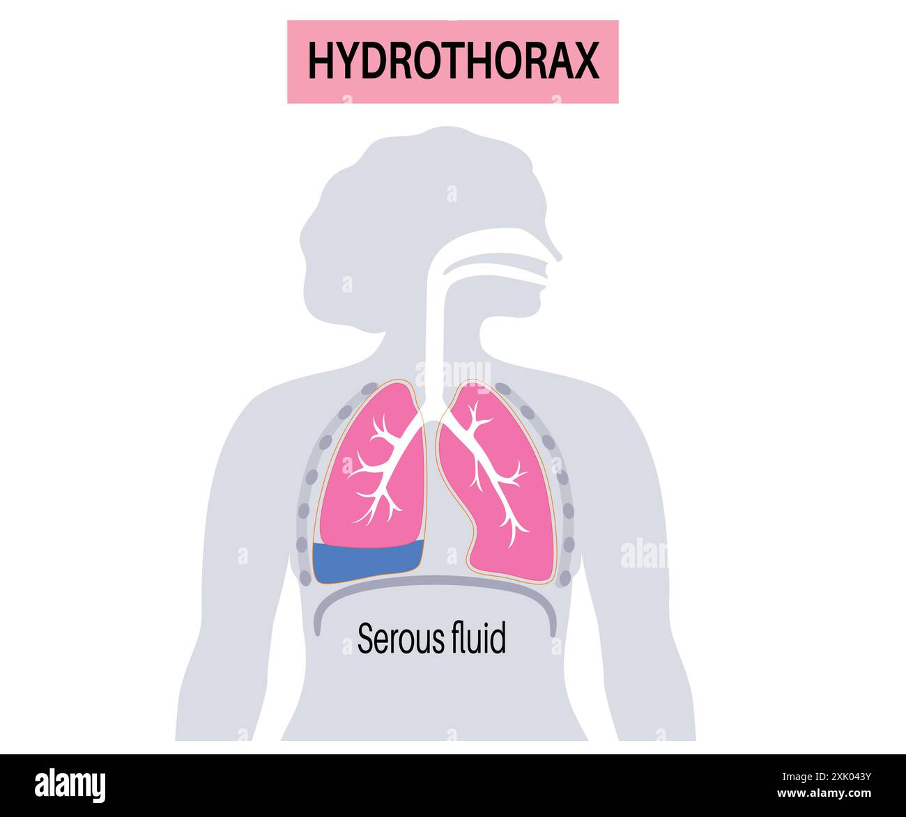 Hydrothorax Medical Illustration - Serous Fluid Accumulation in the ...