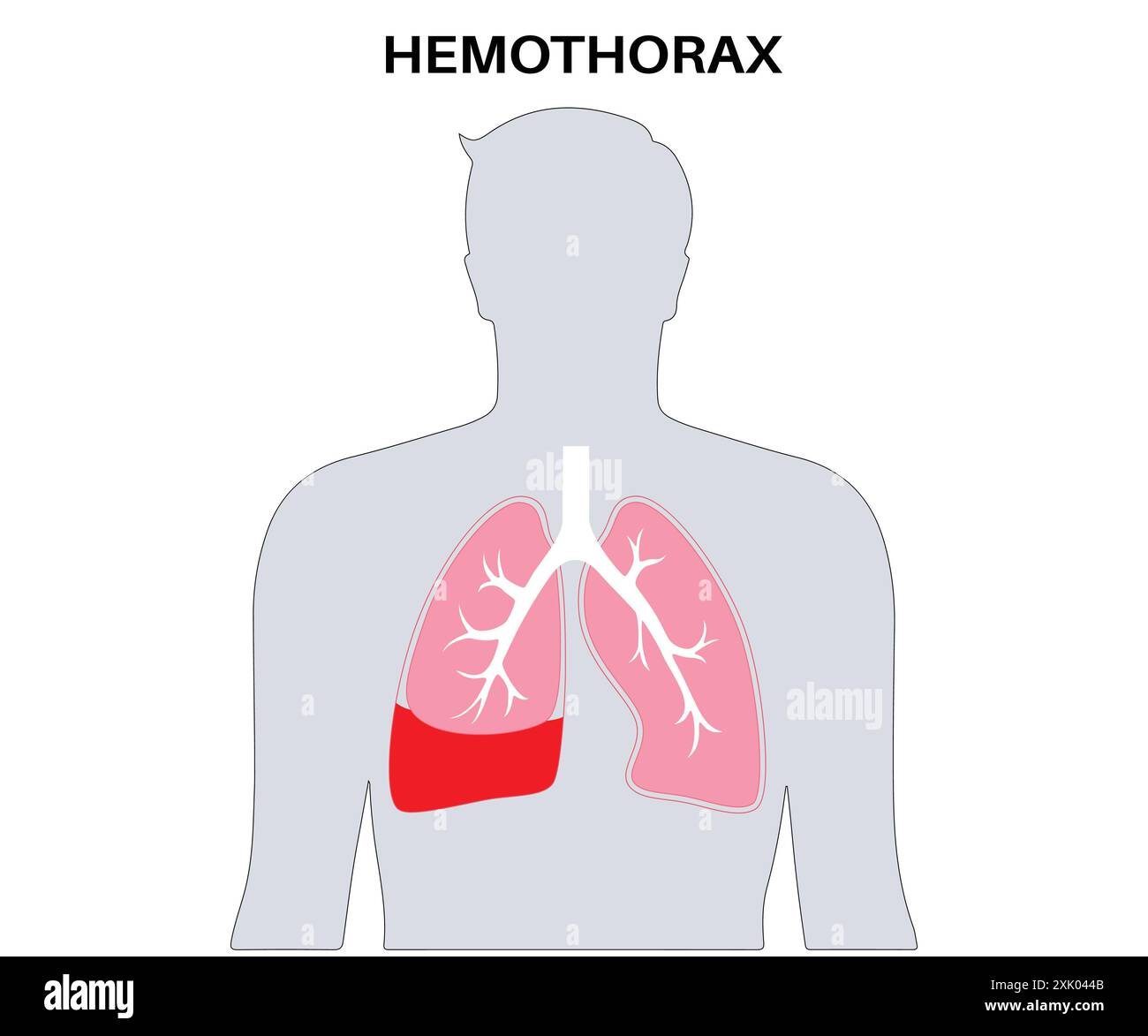 Pulmonary embolism hi-res stock photography and images - Alamy