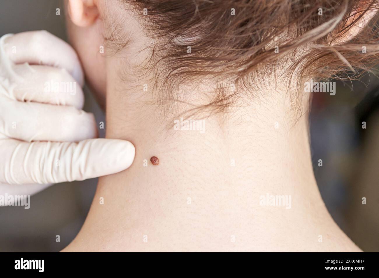Woman examing her abnormal mole. Dermatology procedure. Doctor checking ...