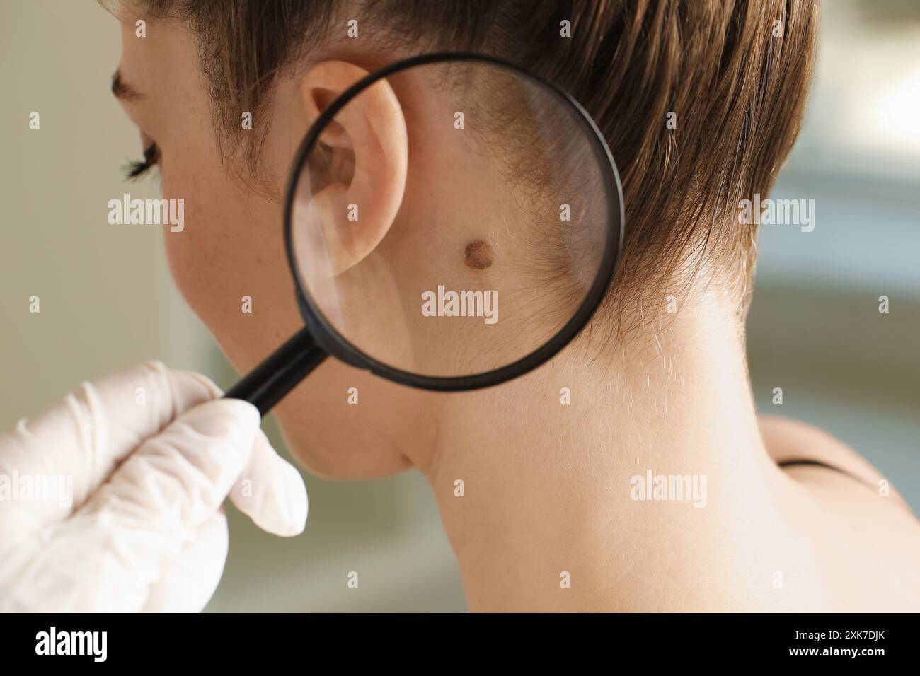 Doctor examining woman's mole with magnifying glass in clinic, closeup ...