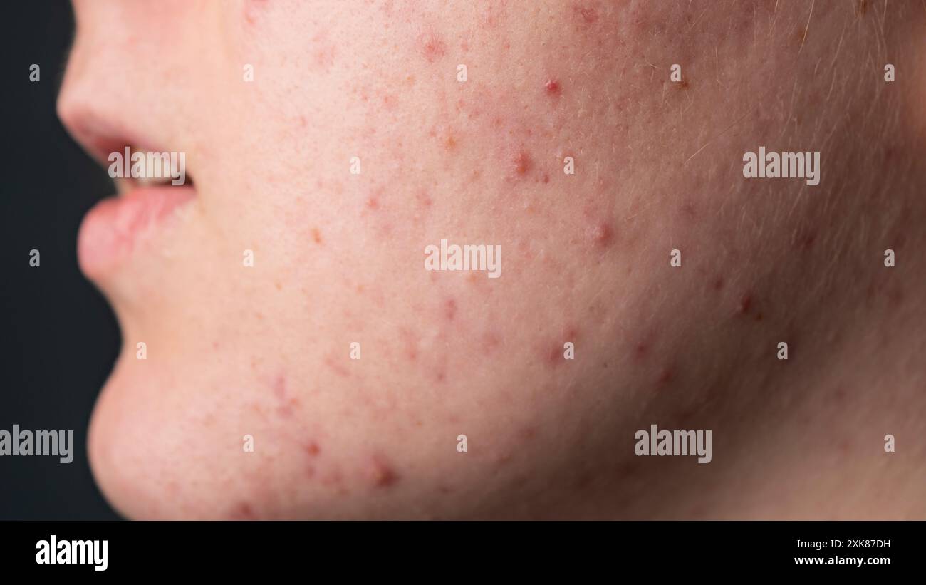 Pimple on face. Skin texture. Closeup acne skin. Treatment for skin ...