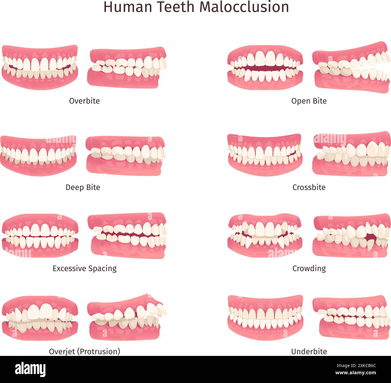 Malocclusion. Tooth open bite protruding mouth jaw problem orthodontics ...