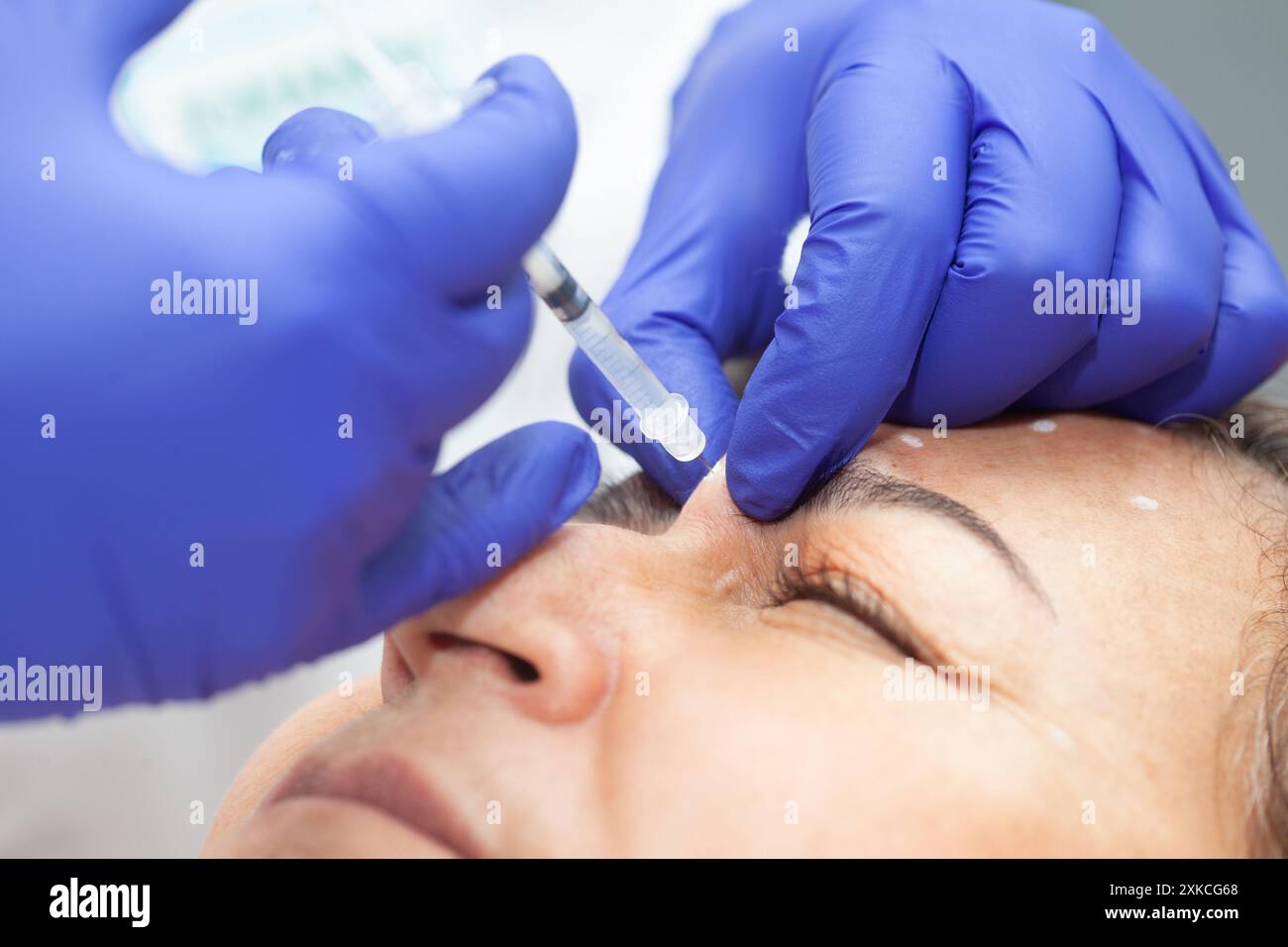 Dermatologist applying Botulinum toxin to a middle age female patient ...