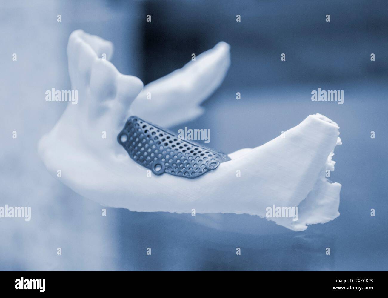 Prototype of lower human jaw with medical titanium implant from ...