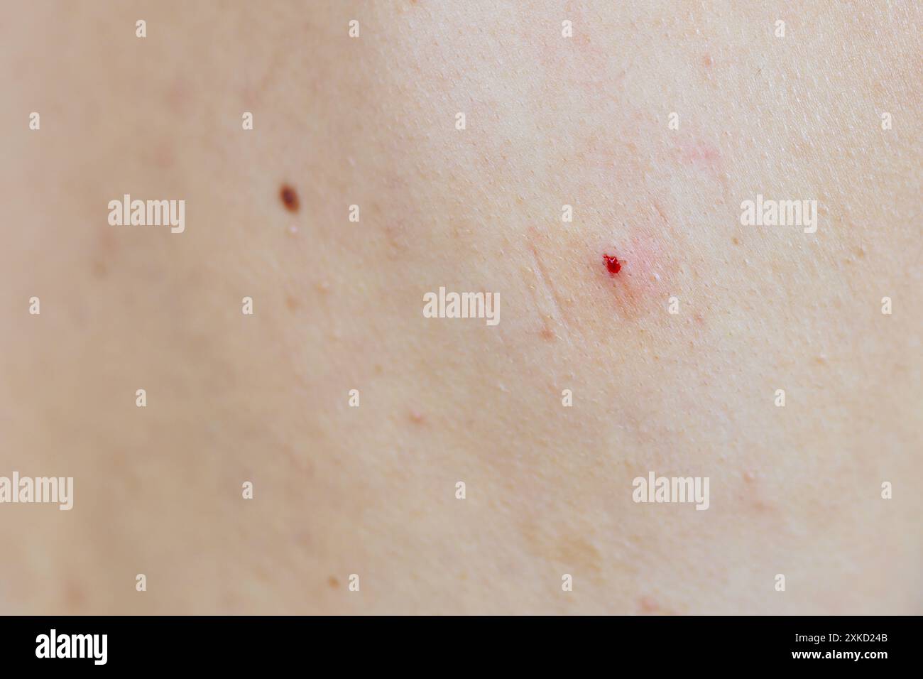 Back wound hi-res stock photography and images - Alamy