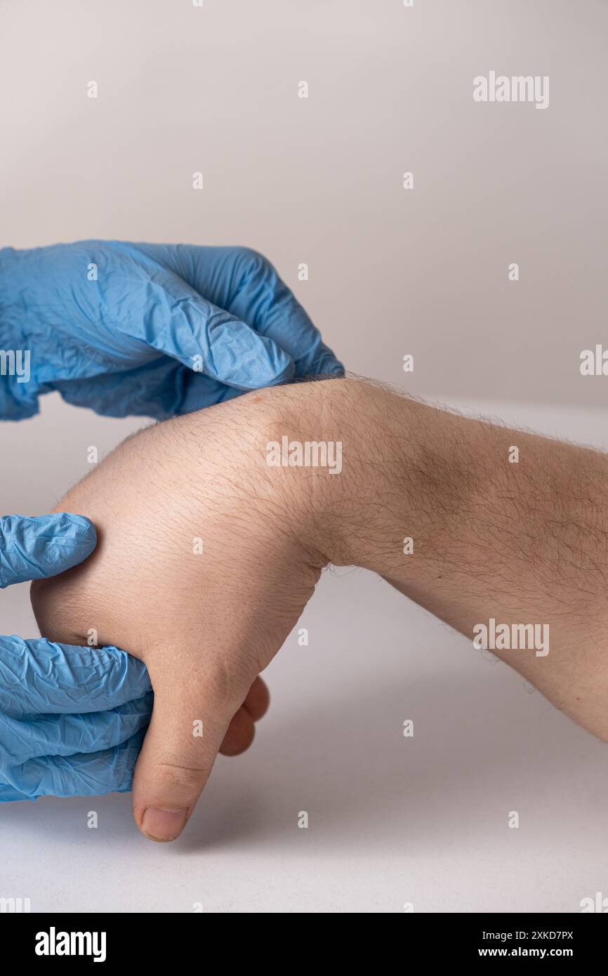 Ganglion cyst or hygroma of the wrist on the hand of a male patient ...
