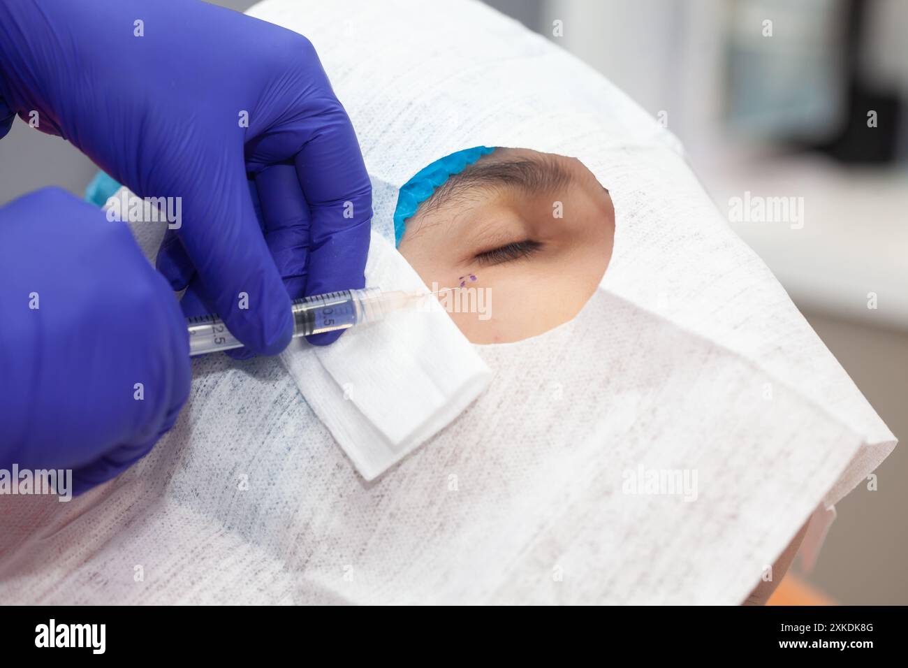 Skin lesion removal procedure. Dermatologist carrying out a removal of ...