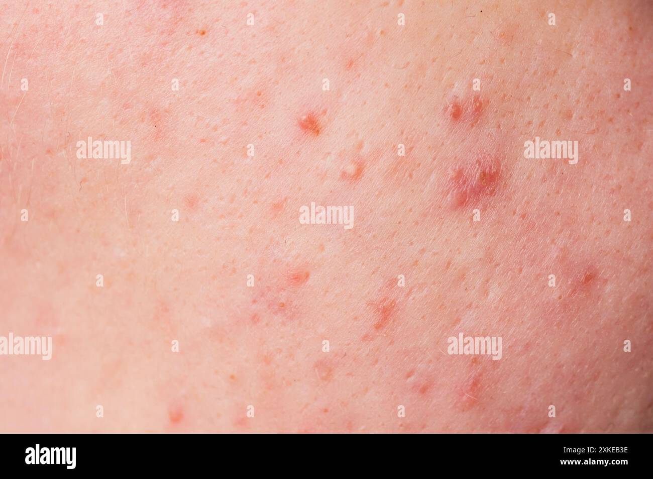 Skin abscess hi-res stock photography and images - Alamy