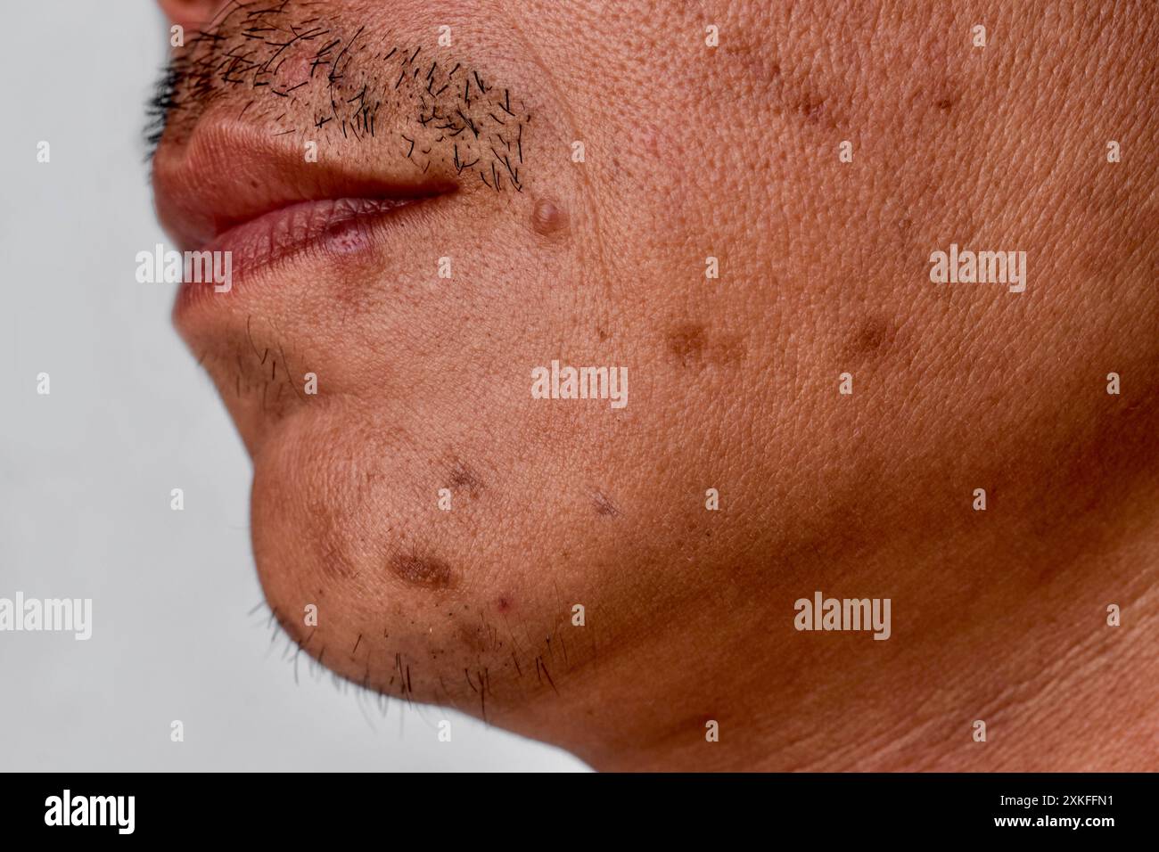 Sun spots face hi-res stock photography and images - Alamy