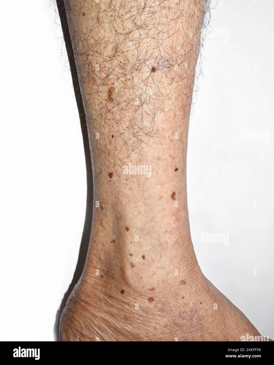 Liver spot hi-res stock photography and images - Alamy