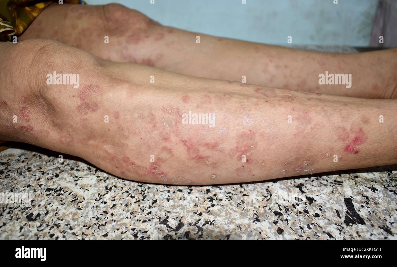 Fungal infection called tinea corporis in leg of Asian woman ...
