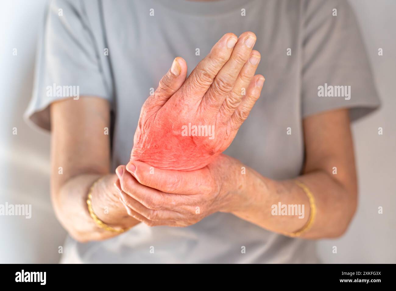 Hand joints inflammation. Concept and idea of rheumatic arthritis ...