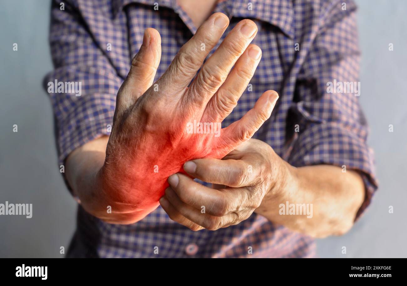 Scabies rash hi-res stock photography and images - Alamy