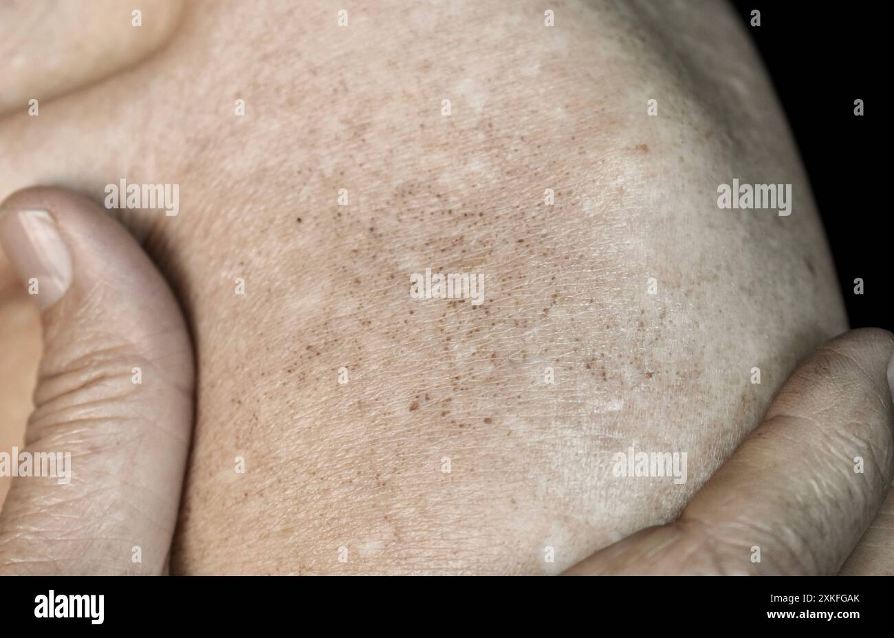 Age spots on body of Asian elder man. They are brown, gray, or black ...
