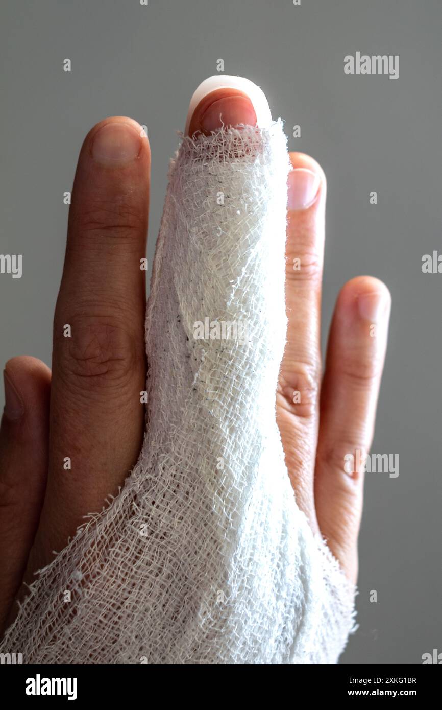 Mallet finger, stack splint on the middle finger with bandage to ...