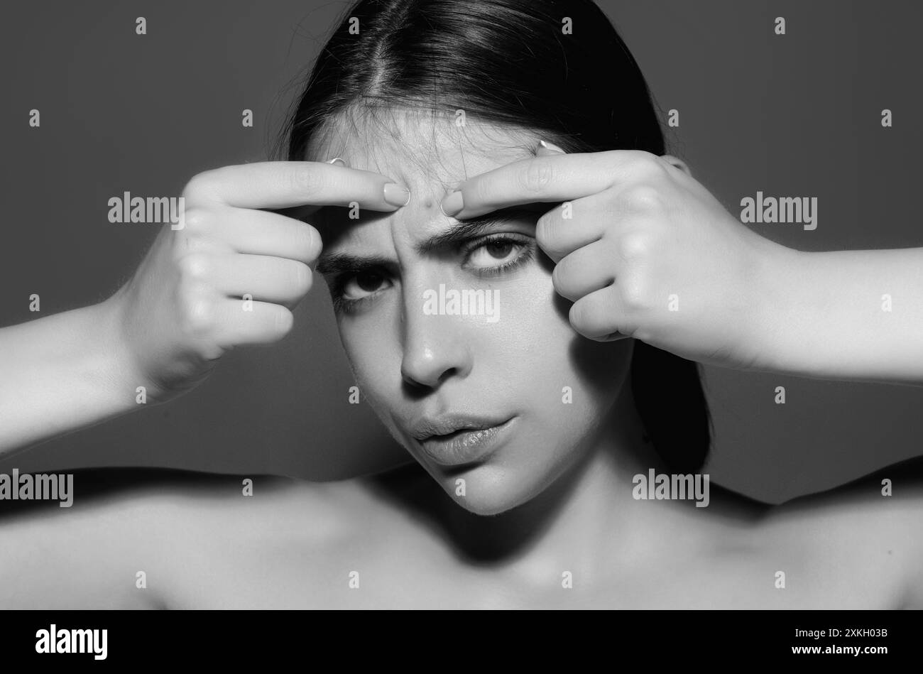 Young Woman Squeeze pimples. Girl with Acne and Pimple on Skin ...