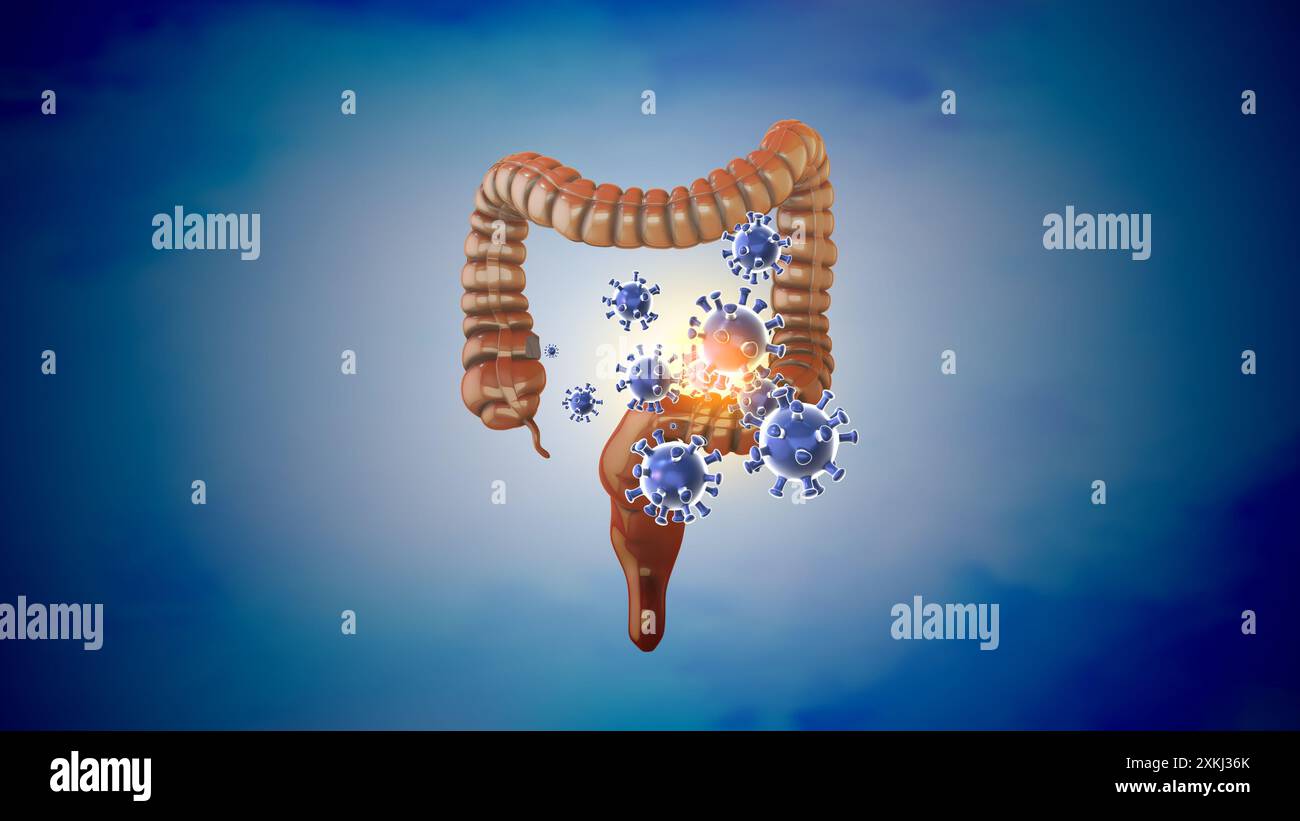 Medical concept of a large intestinal infection Stock Photo - Alamy