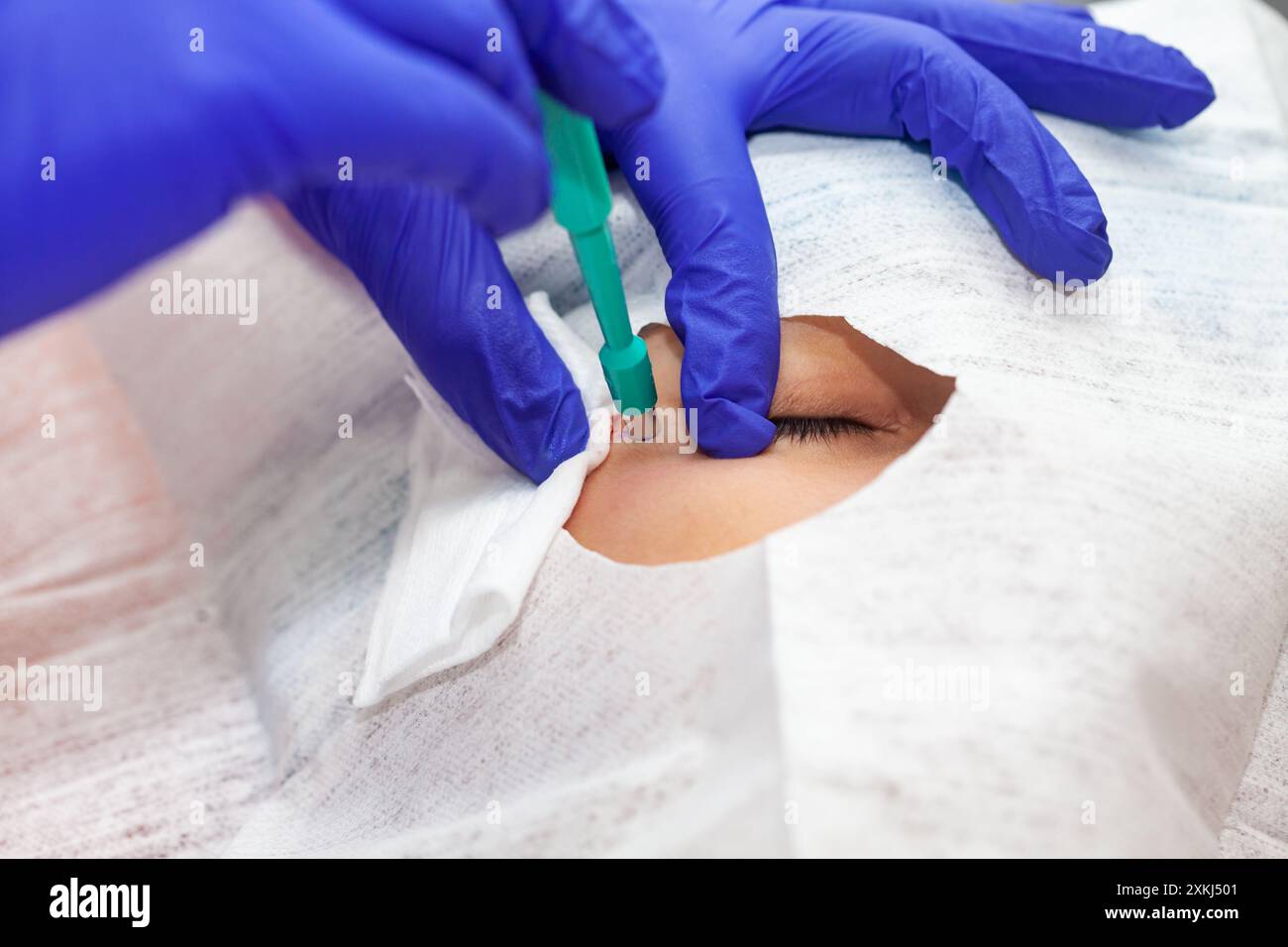 Skin lesion removal procedure. Dermatologist carrying out a removal of ...