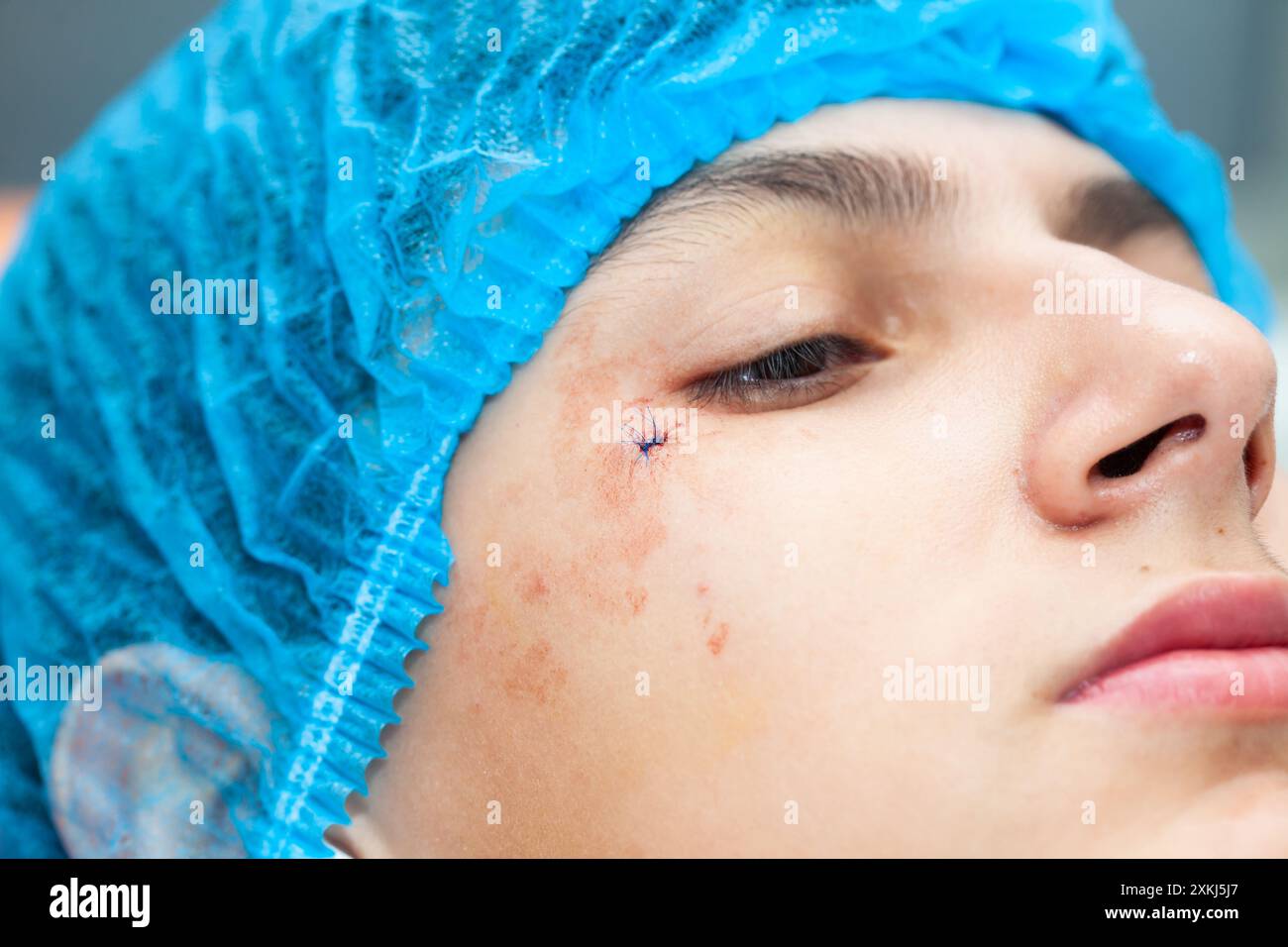 Close up of a young male patient face after a benign skin lesion ...