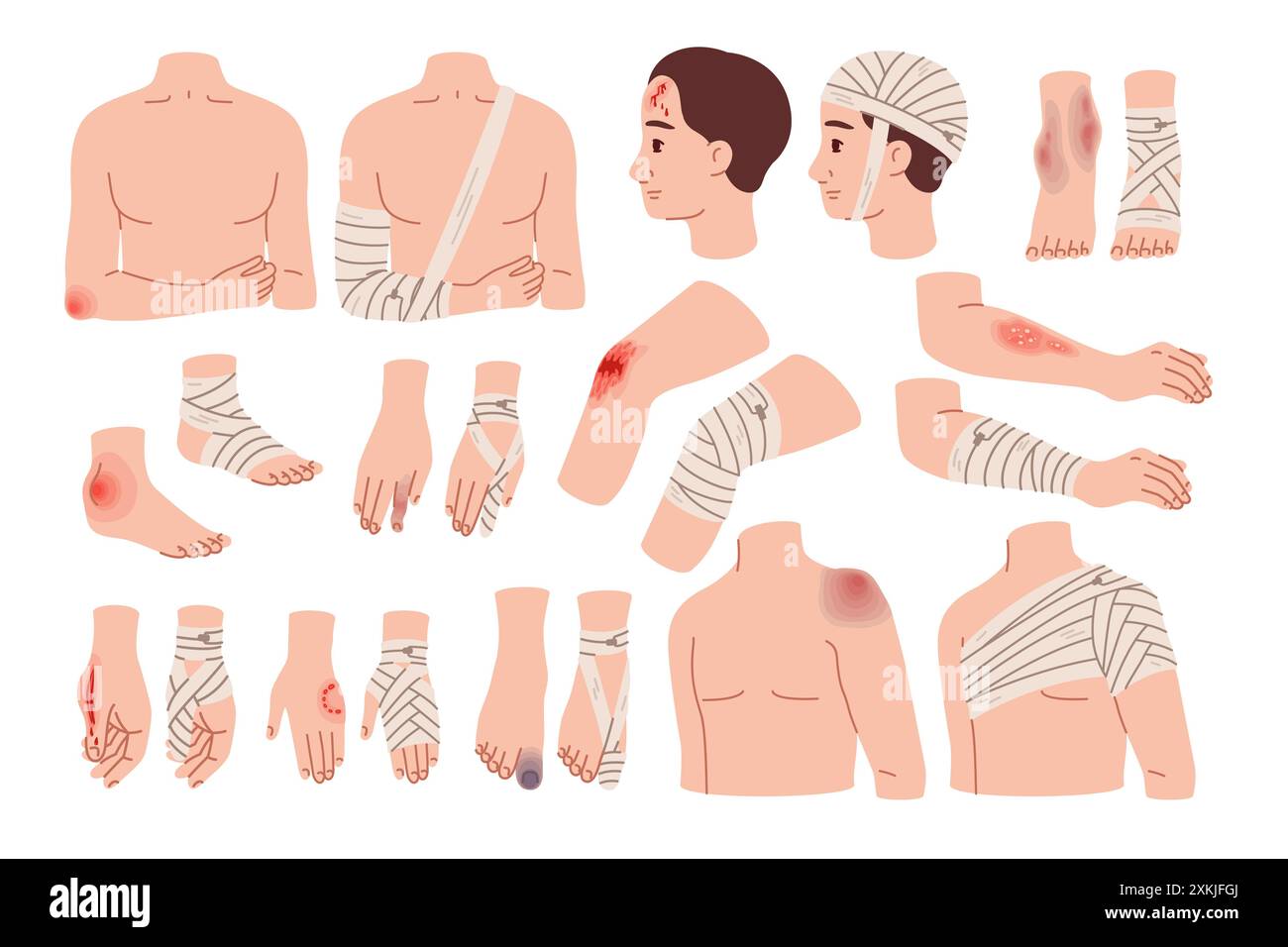 Applying bandages to wounds. Fixation and isolation of bruises. Bone ...