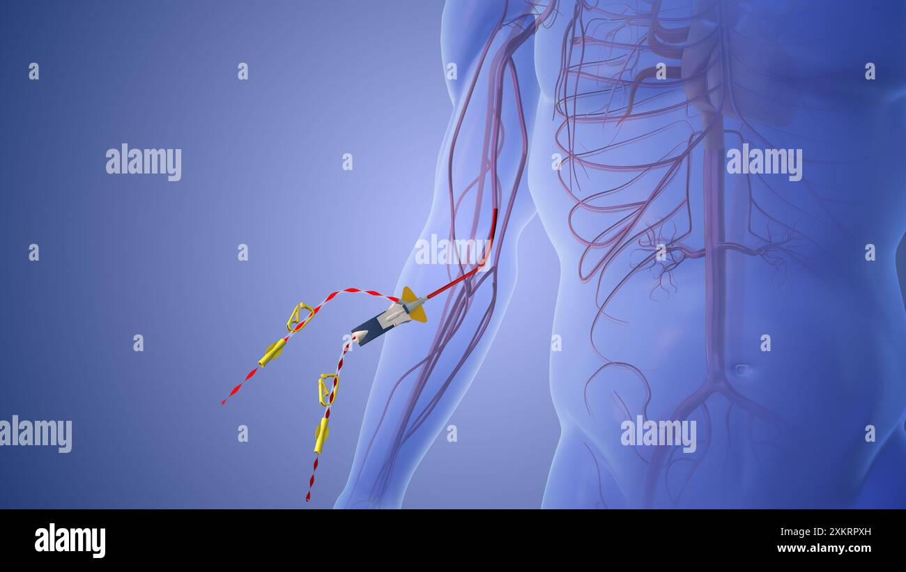 Picc port hi-res stock photography and images - Alamy
