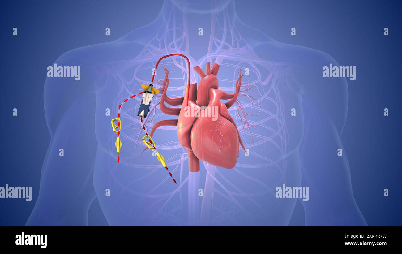 Chemotherapy port inserted inside body with a catheter Stock Photo - Alamy