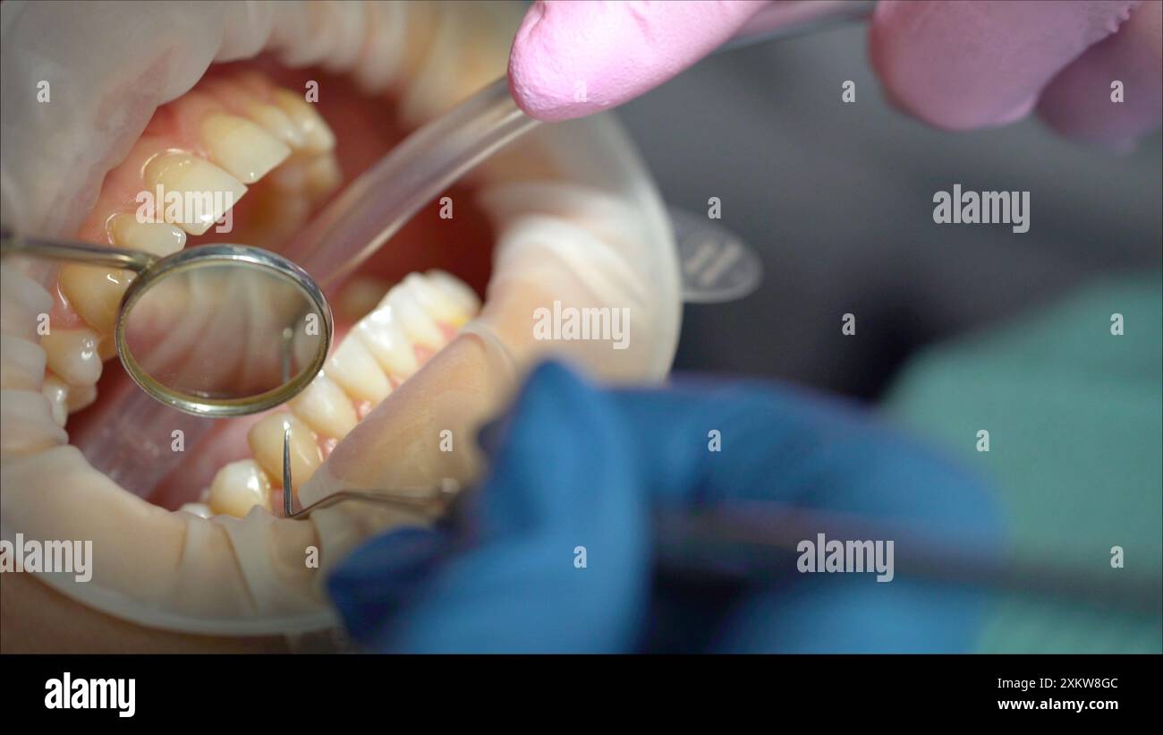 Dentist examining a patient's teeth in the dentist. Examination of the ...