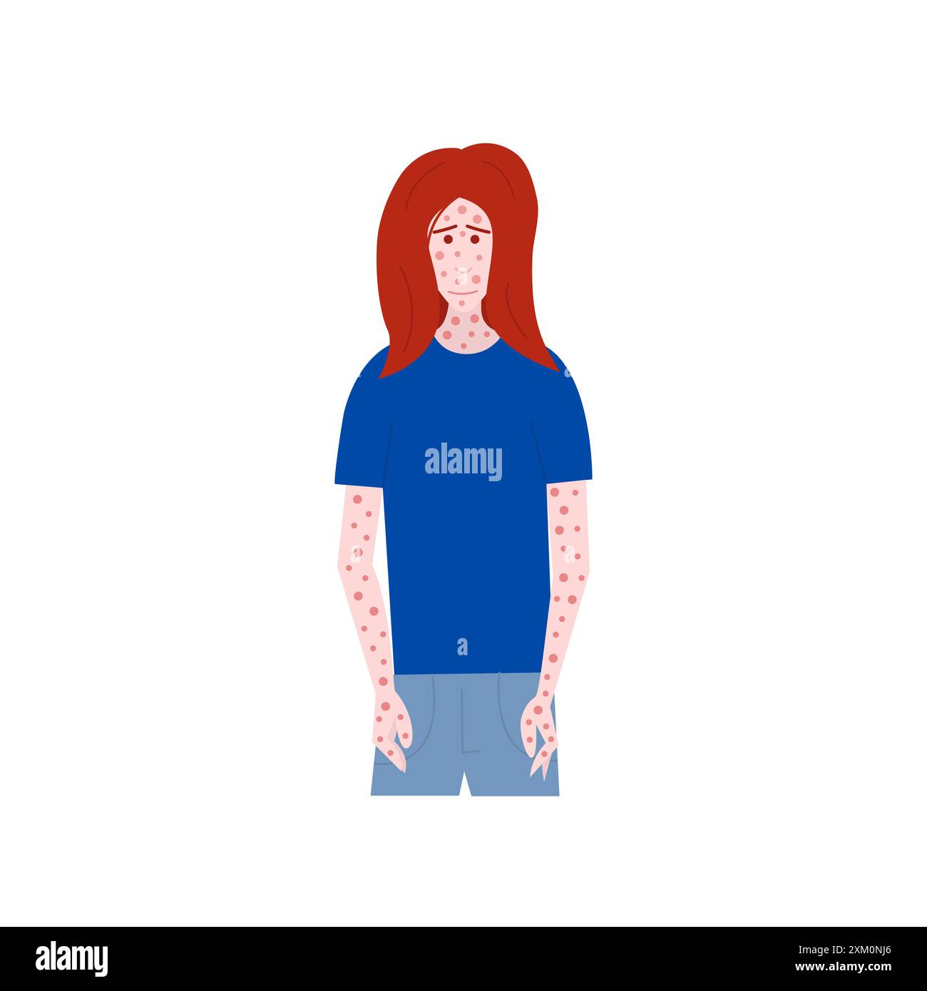 Monkey pox outbreak vector virus illustration Stock Vector Image & Art ...