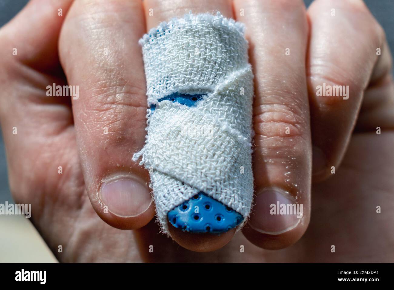 Mallet finger with custom orthosis on the middle finger to immobilize ...