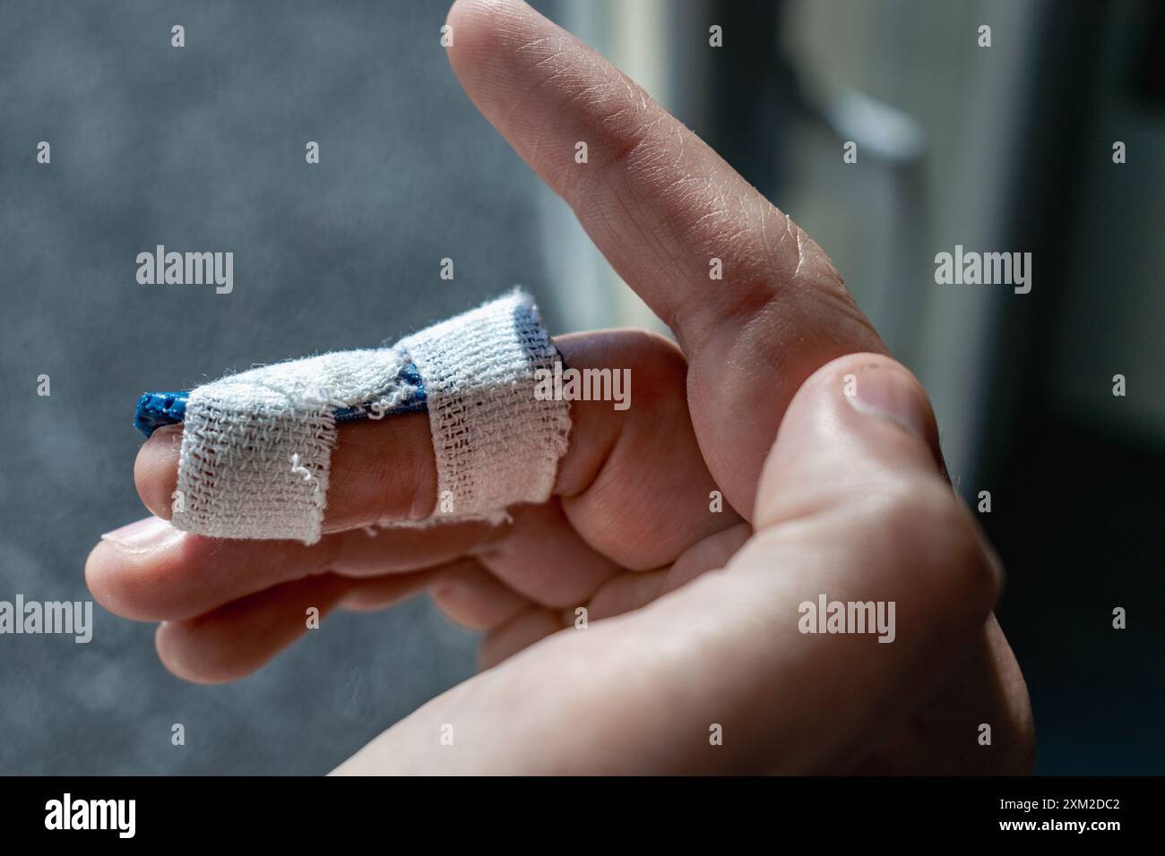 Mallet finger with custom orthosis on the middle finger to immobilize ...