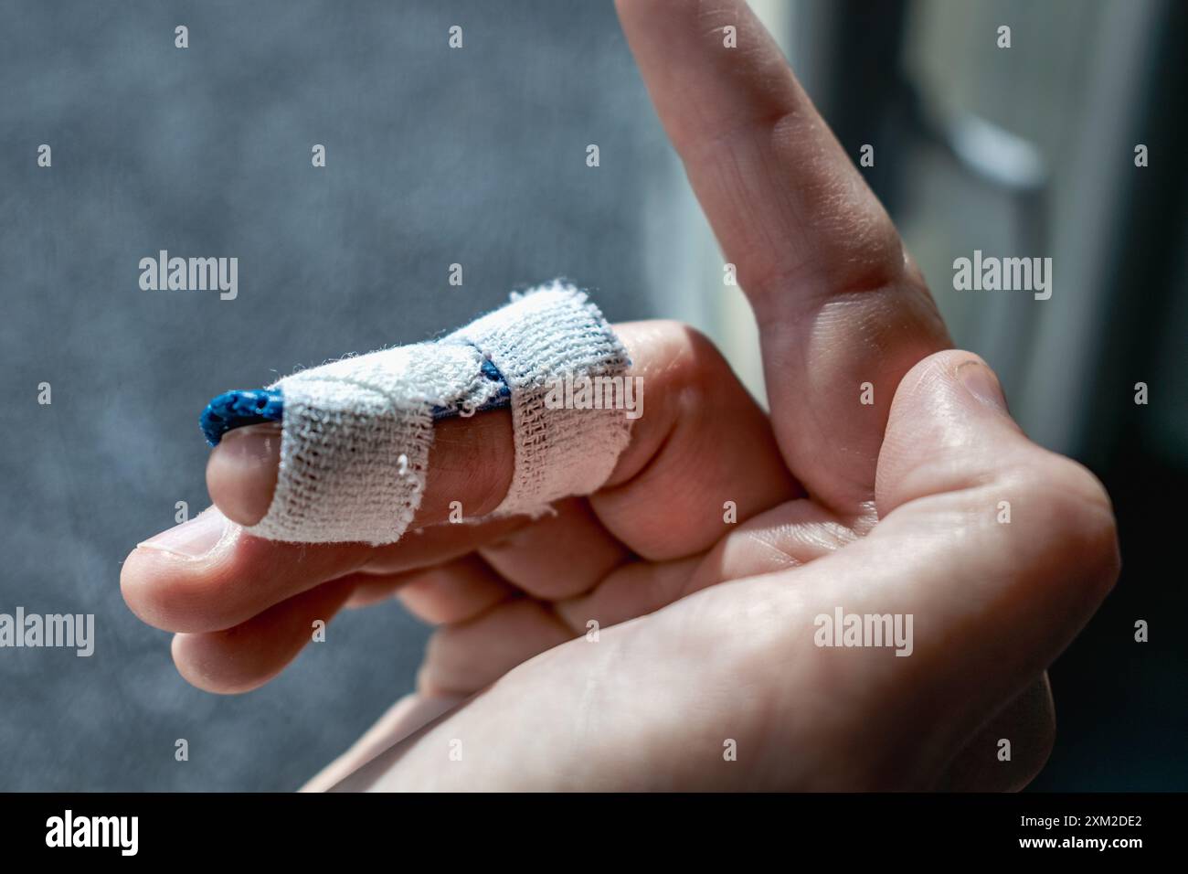 Mallet finger with custom orthosis on the middle finger to immobilize ...